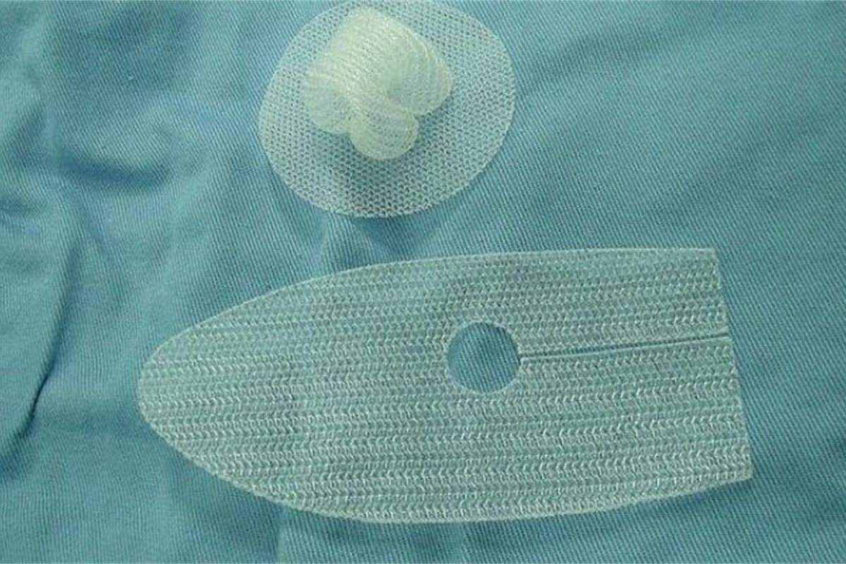 Holyrood Article | National mesh removal service to be set up in Scotland